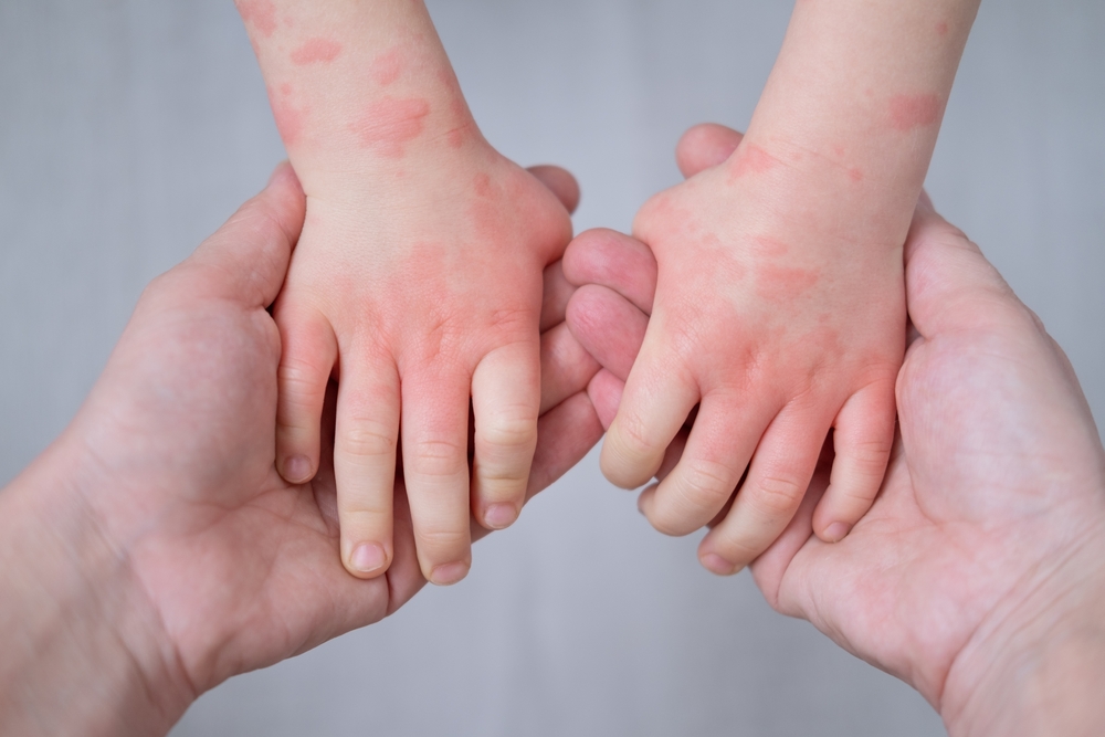 Tips for Eczema in Babies and Children | Dermal Therapy